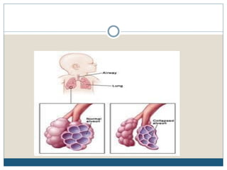 Atelectasis | PDF