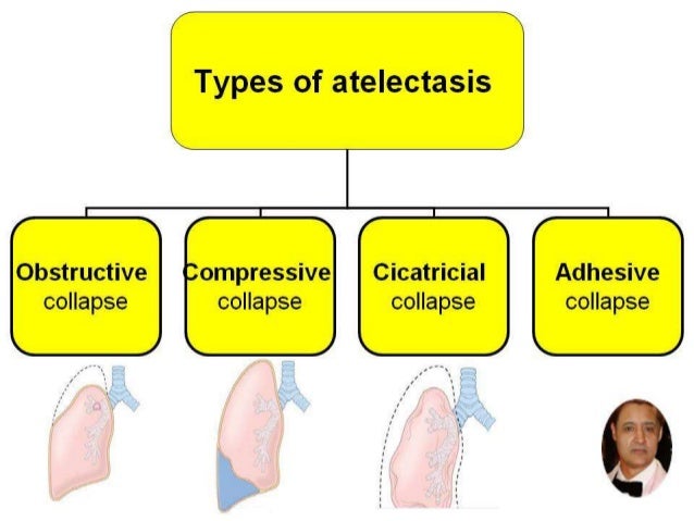 Atelectasis/Lung Collapse Part-1 by Dr Bashir Ahmed Dar Associate Pro…