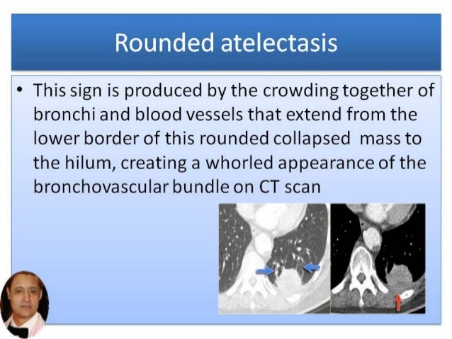 Atelectasis/Lung Collapse Part-1 by Dr Bashir Ahmed Dar Associate Pro…