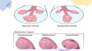 Atelectasis ppt.pptx COLLAPSE OF LUNG (partial or complete) | PPTX