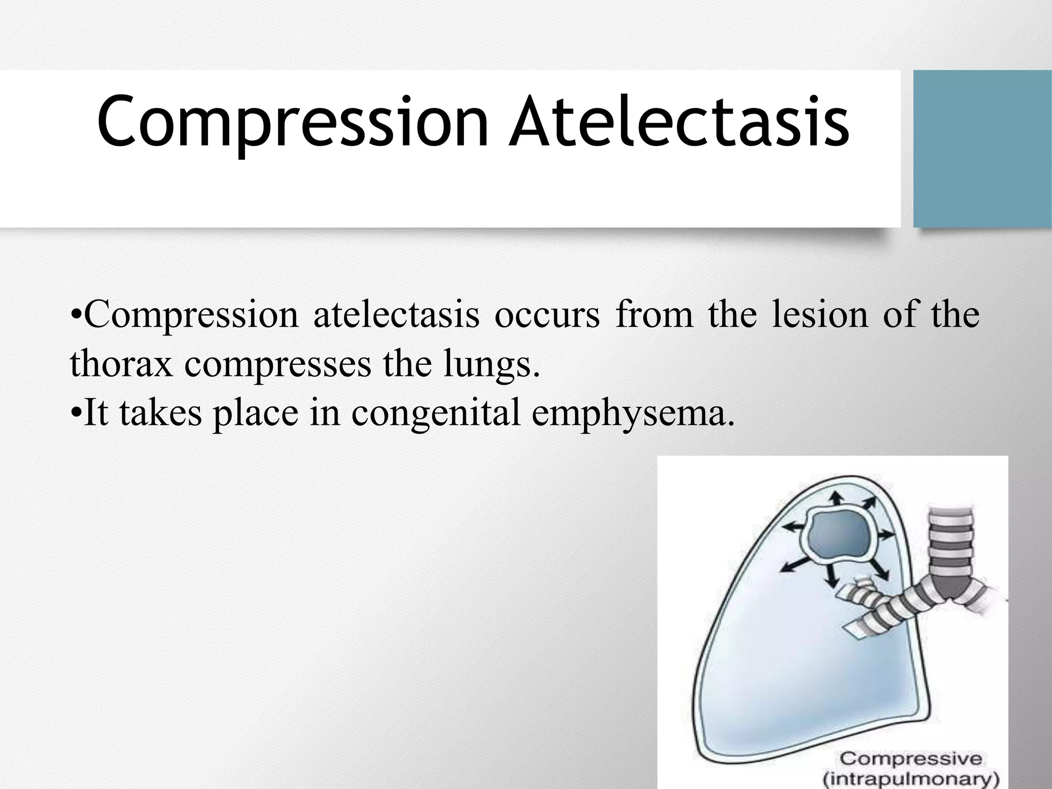 Atelectasis - a respiratory disorder | PPTX
