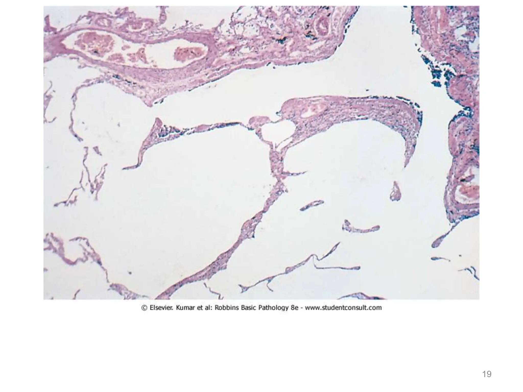 Atelectasis, restrictive and obstructive pulmonary disease.pptx