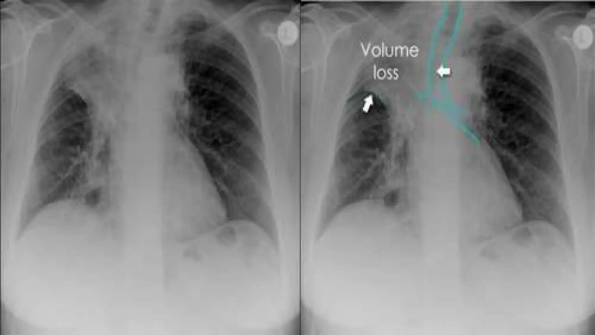 atelectasis x ray review under radiology studies | PPTX
