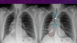 atelectasis x ray review under radiology studies | PPTX