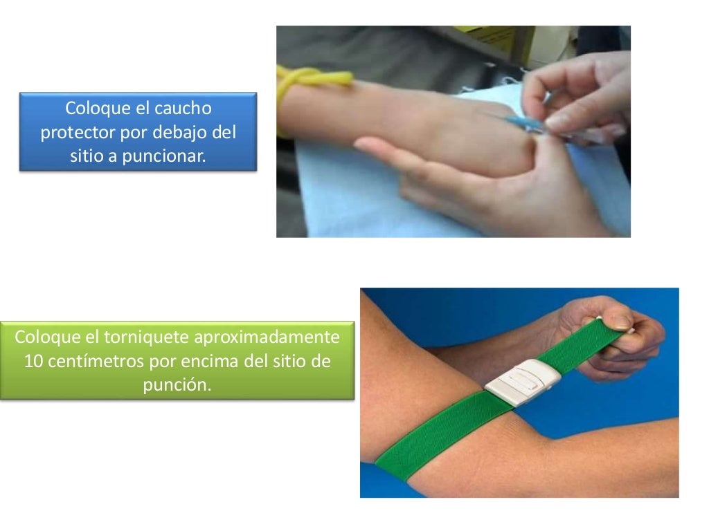 CanalizaciÓn De Vena