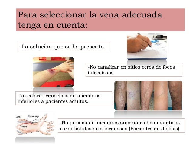 CanalizaciÓn De Vena