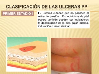 Atención Enfermeria en Úlceras por Decubito | PPT