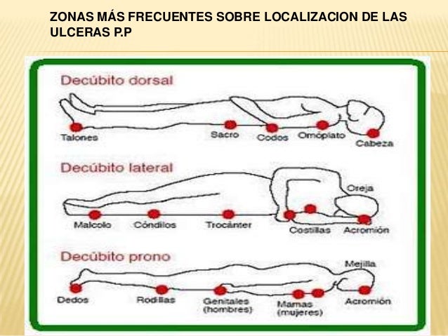 Atención Enfermeria en Úlceras por Decubito