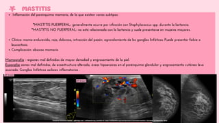 MASTITIS GRANULOMATOSA VS CANCER INFLAMATORIO DE MAMA | PDF