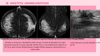 MASTITIS GRANULOMATOSA VS CANCER INFLAMATORIO DE MAMA | PDF