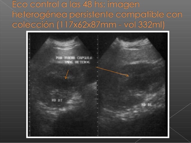 Ateneo Absceso Renal