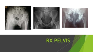 POLITRAUMATIZADO PELVIS.pptx