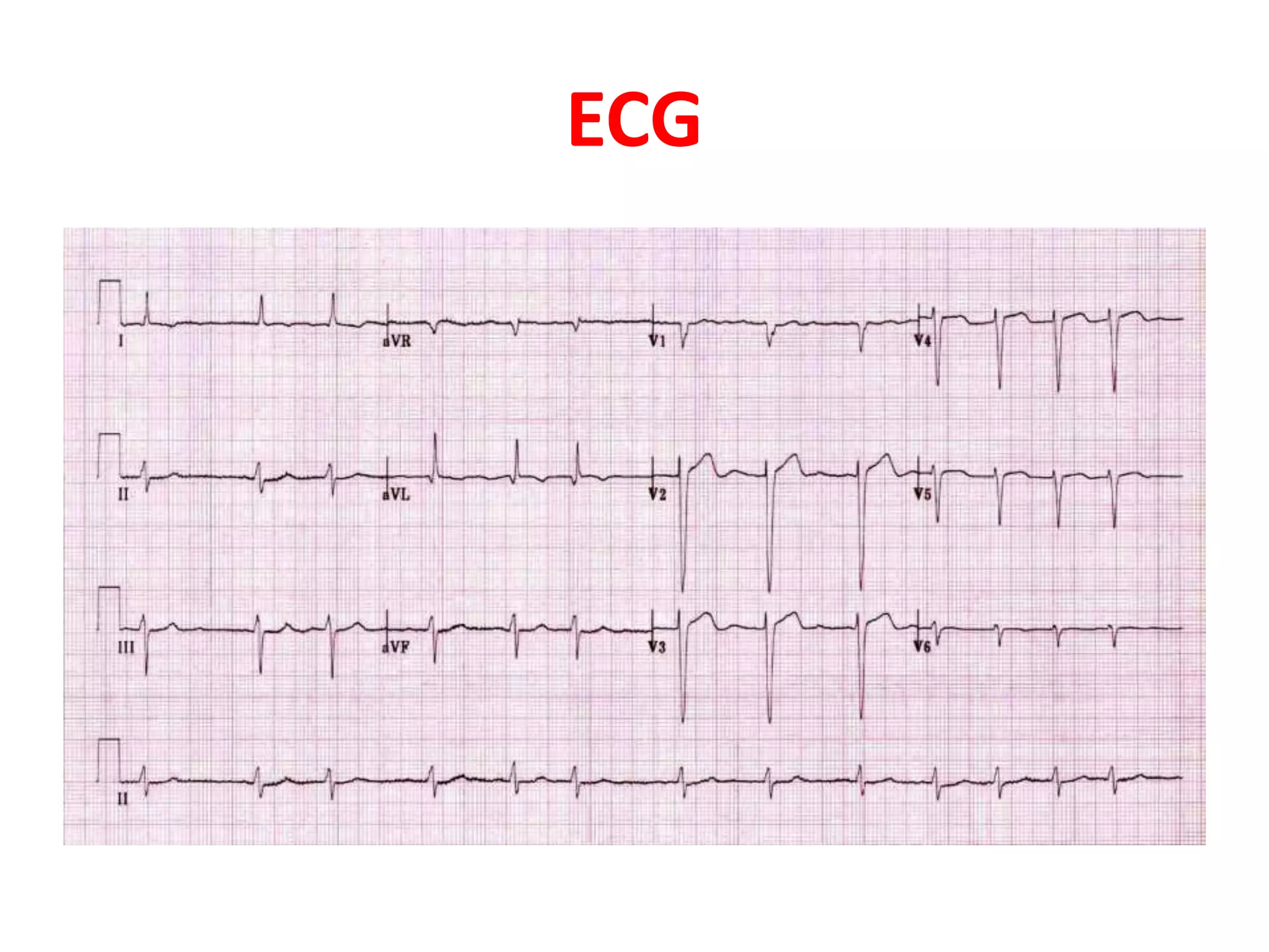 Aterial fibrillation acls | PPT