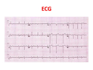 Aterial fibrillation acls | PPT