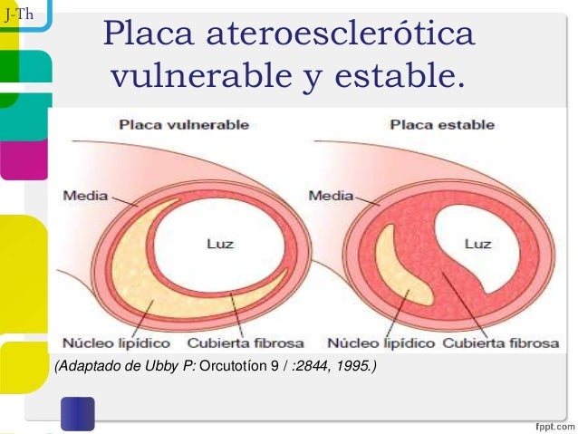 Aterosclerosis