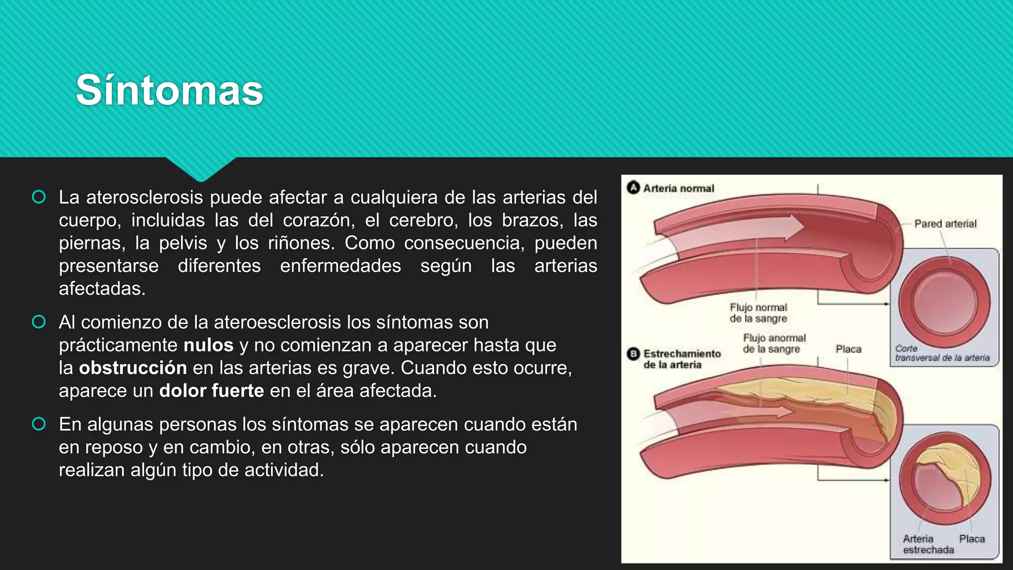 Aterosclerosis - Diagnóstico y Tratamiento | PPT