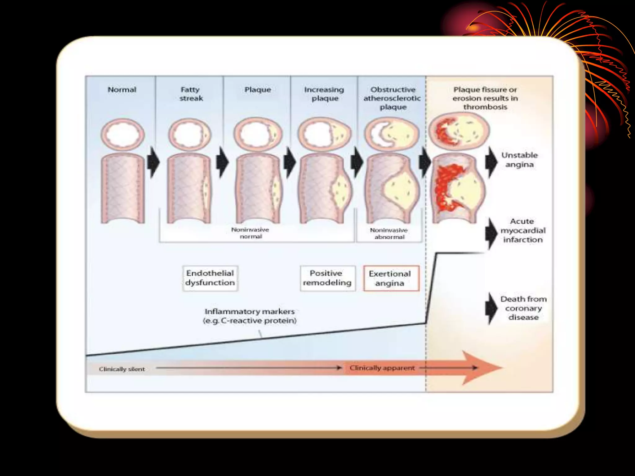 Fisiopatologia de la Aterosclerosis | PPT