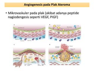Aterosklerosis | PPTX