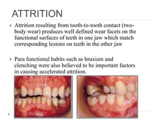 TOOTH WEAR | PPTX