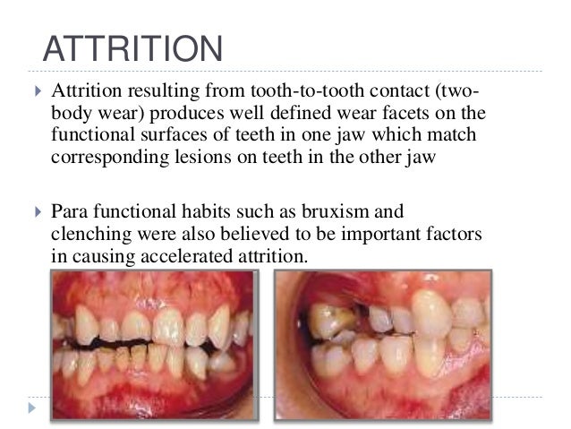 TOOTH WEAR