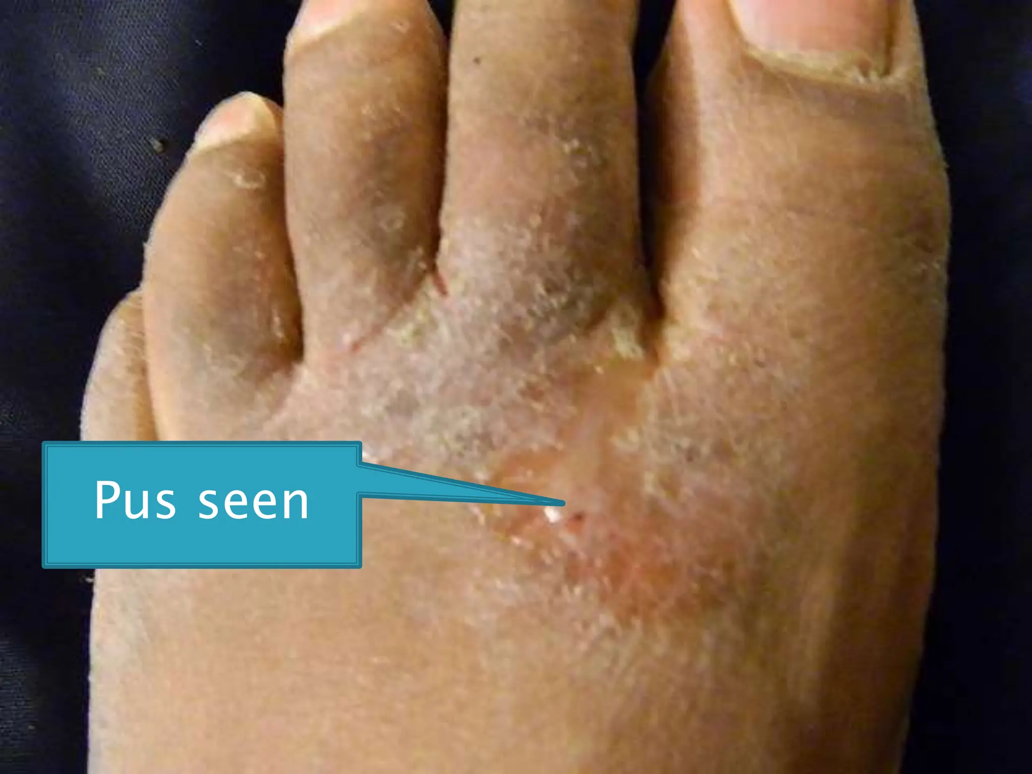 Athelete Foot Symptoms, Care and Prevention .pptx