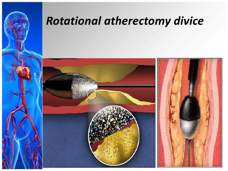 Atherectomy
