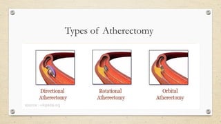ATHERECTOMY AND ALSO CALLED ATHERCTOMY ATHERECTOMY | PPTX