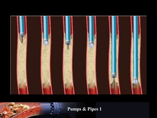 Atherectomy and Plaque Analysis, pumpsandpipesmdhc | PPT