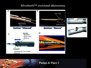 Atherectomy and Plaque Analysis, pumpsandpipesmdhc | PPT