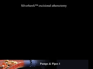 Atherectomy and Plaque Analysis, pumpsandpipesmdhc | PPT
