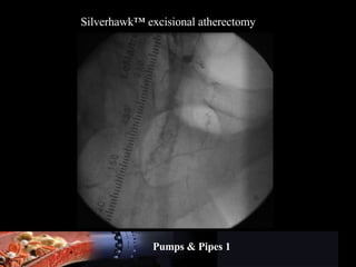 Atherectomy and Plaque Analysis, pumpsandpipesmdhc | PPT