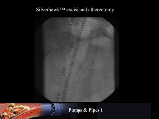 Atherectomy and Plaque Analysis, pumpsandpipesmdhc | PPT