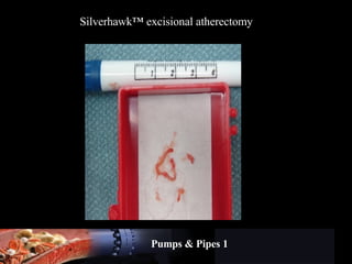 Atherectomy and Plaque Analysis, pumpsandpipesmdhc | PPT