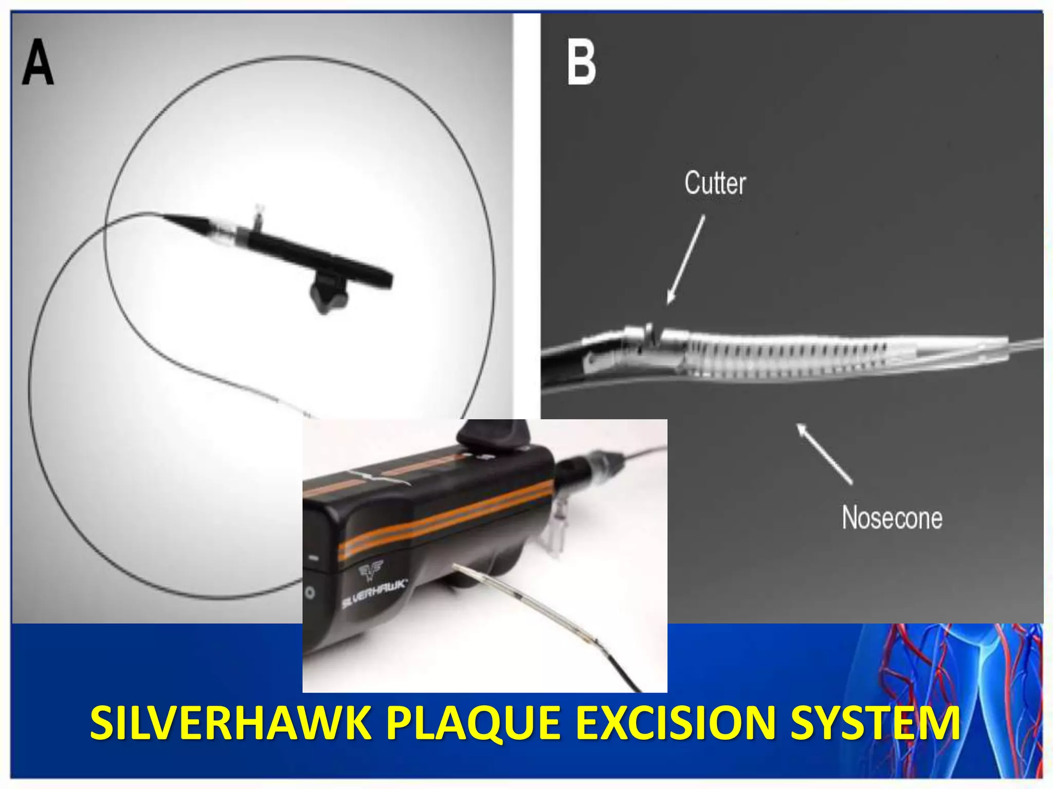 Atherectomy devices | PPTX