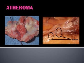 Atheroma | PPTX