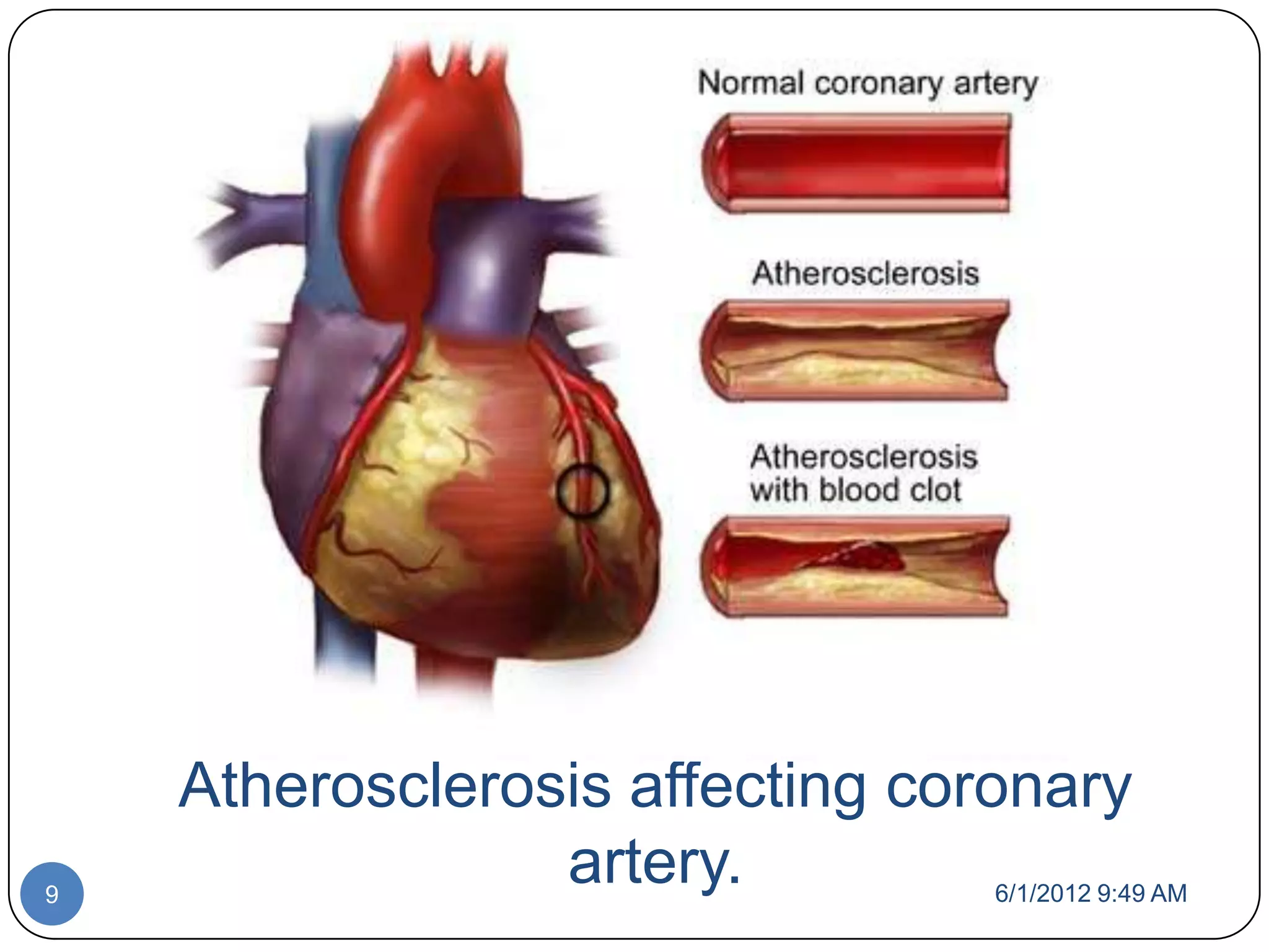 Atherosclerosis | PPTX