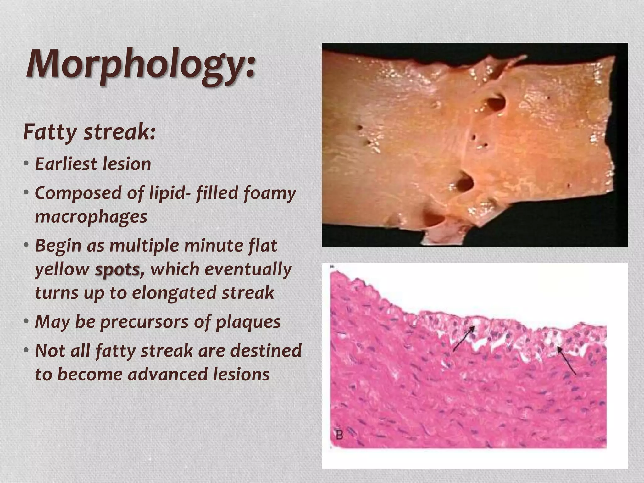 Atherosclerosis | PPTX