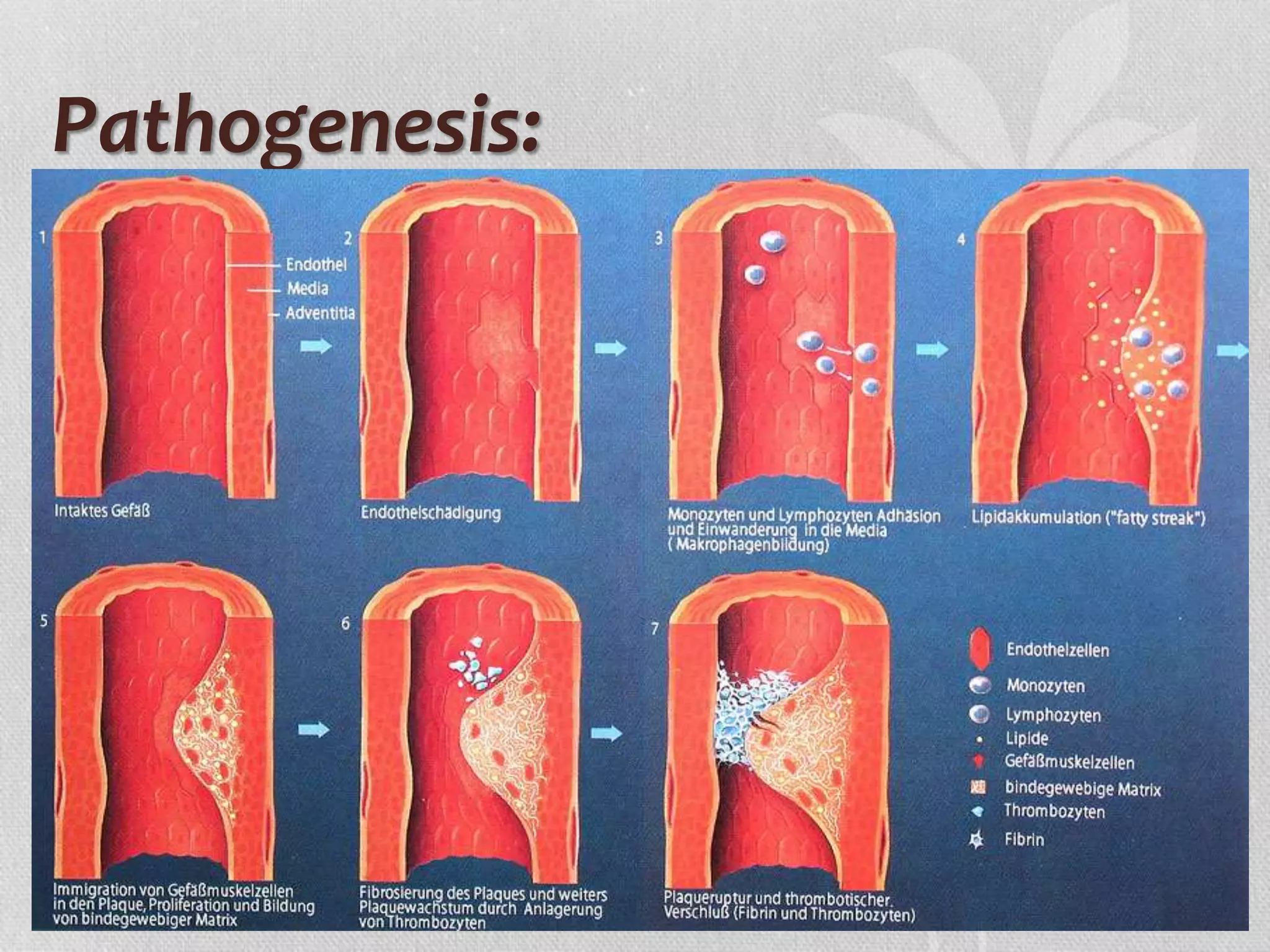 Atherosclerosis | PPTX