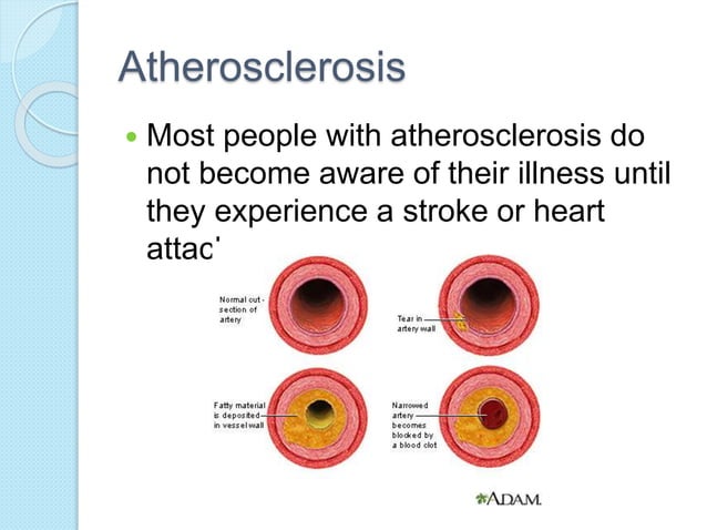 Atherosclerosis | PPT