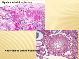 Hyperplastic Arteriosclerosis