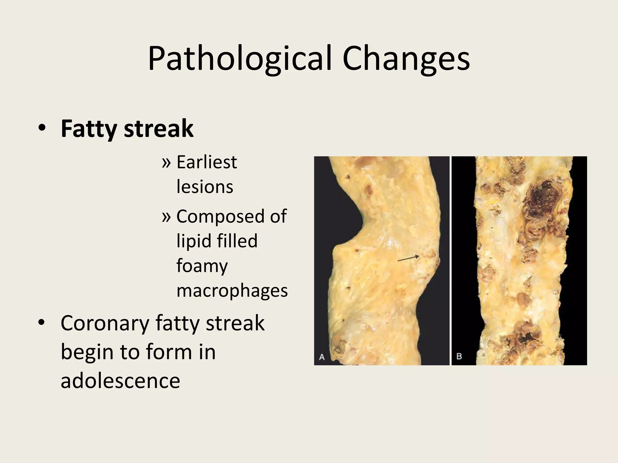 Atherosclerosis | PPTX