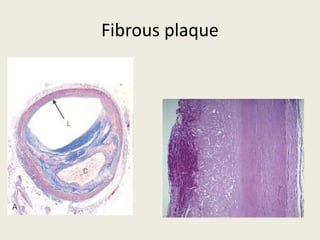 Atherosclerosis | PPTX