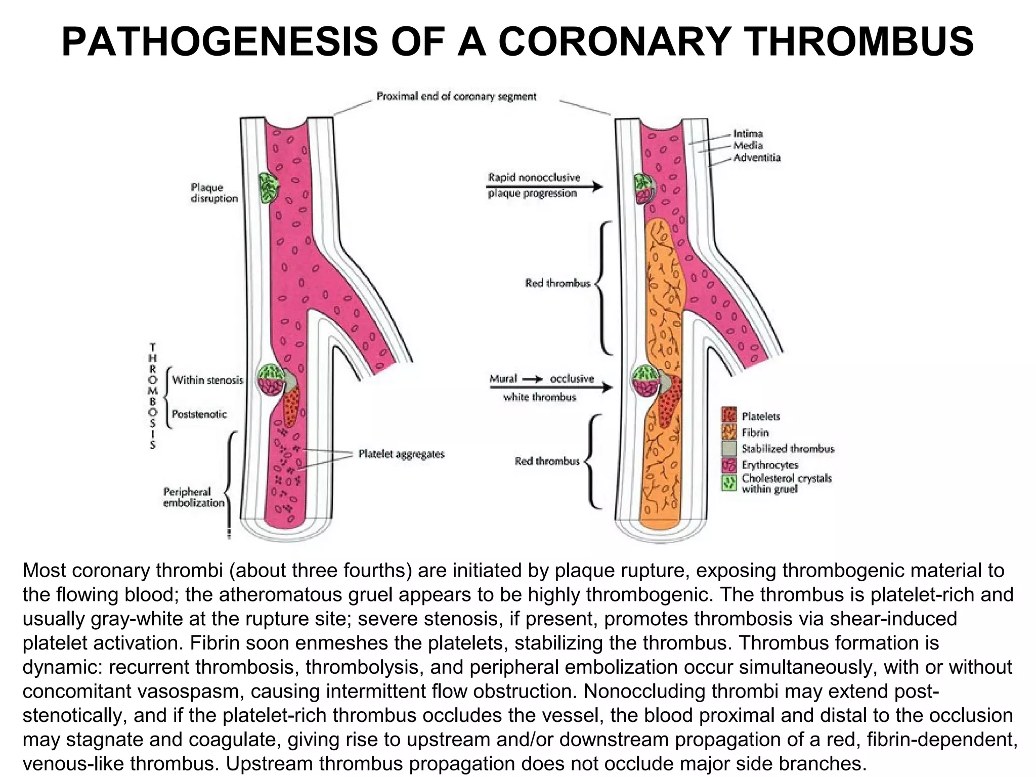 Atherosclerosis | PPT