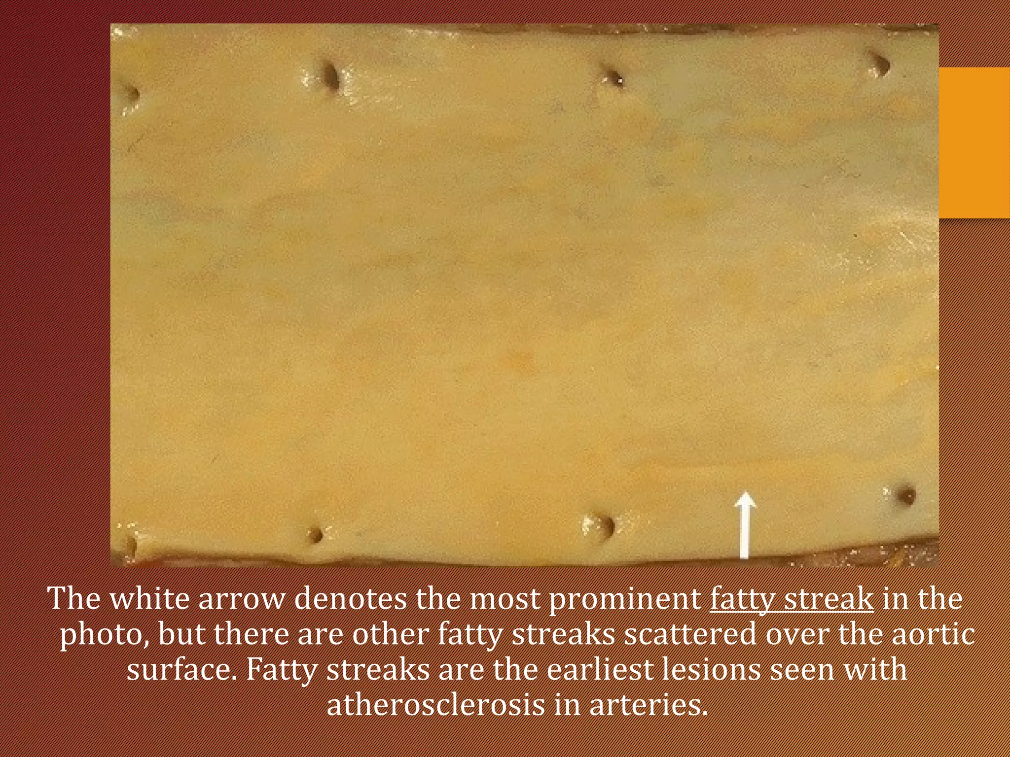 Atherosclerosis | PPT