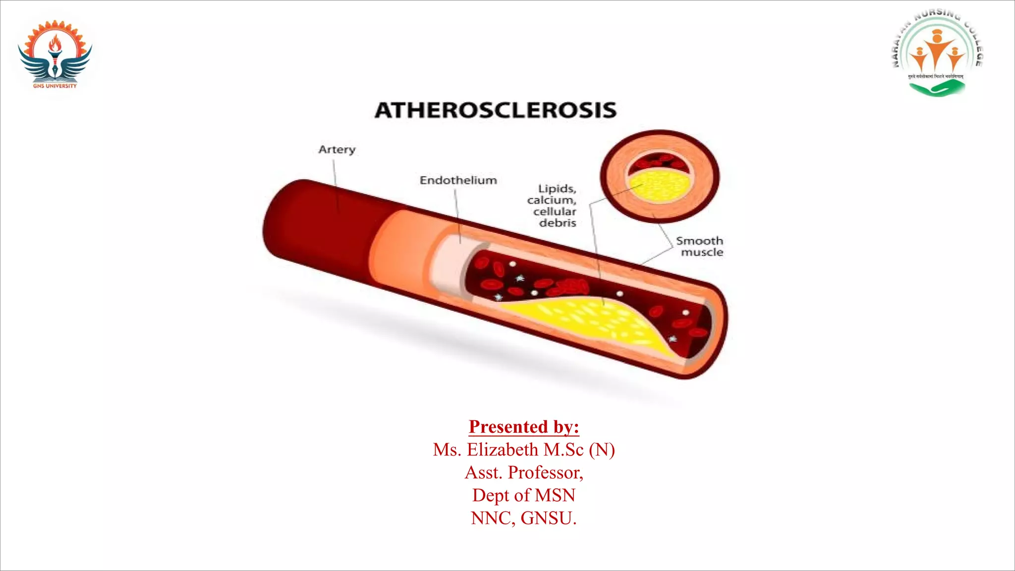 Atherosclerosis | PDF