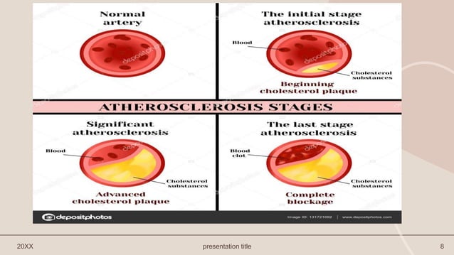 ATHEROSCLEROSIS.pptx