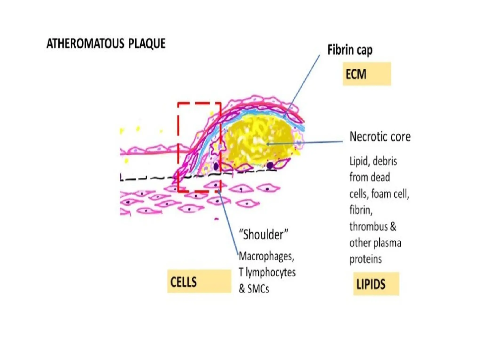 Atherosclerosis Detailed Pathophysiology | PPTX
