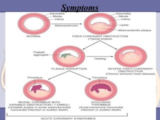 Atherosclerosis.pptx By Akshay Mistry .. | PPTX