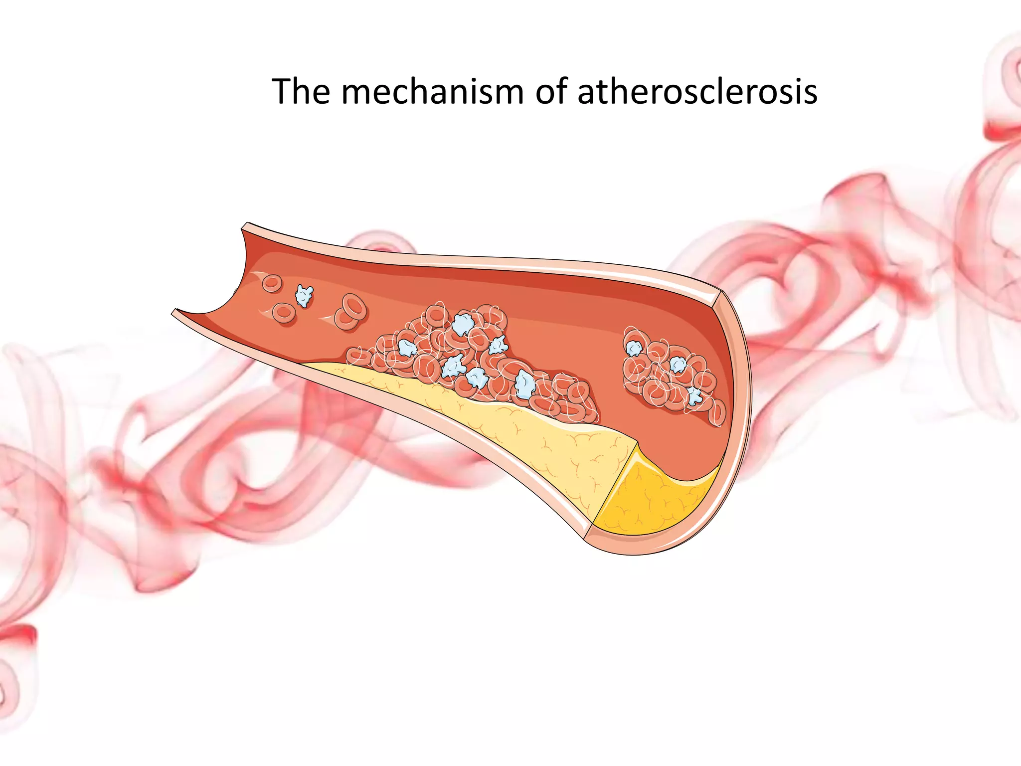 Atherosclerosis creative diagnostic | PPTX | Heart and Cardiovascular ...