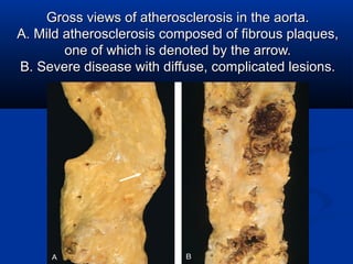 Atherosclerosis and aneurysm | PPT